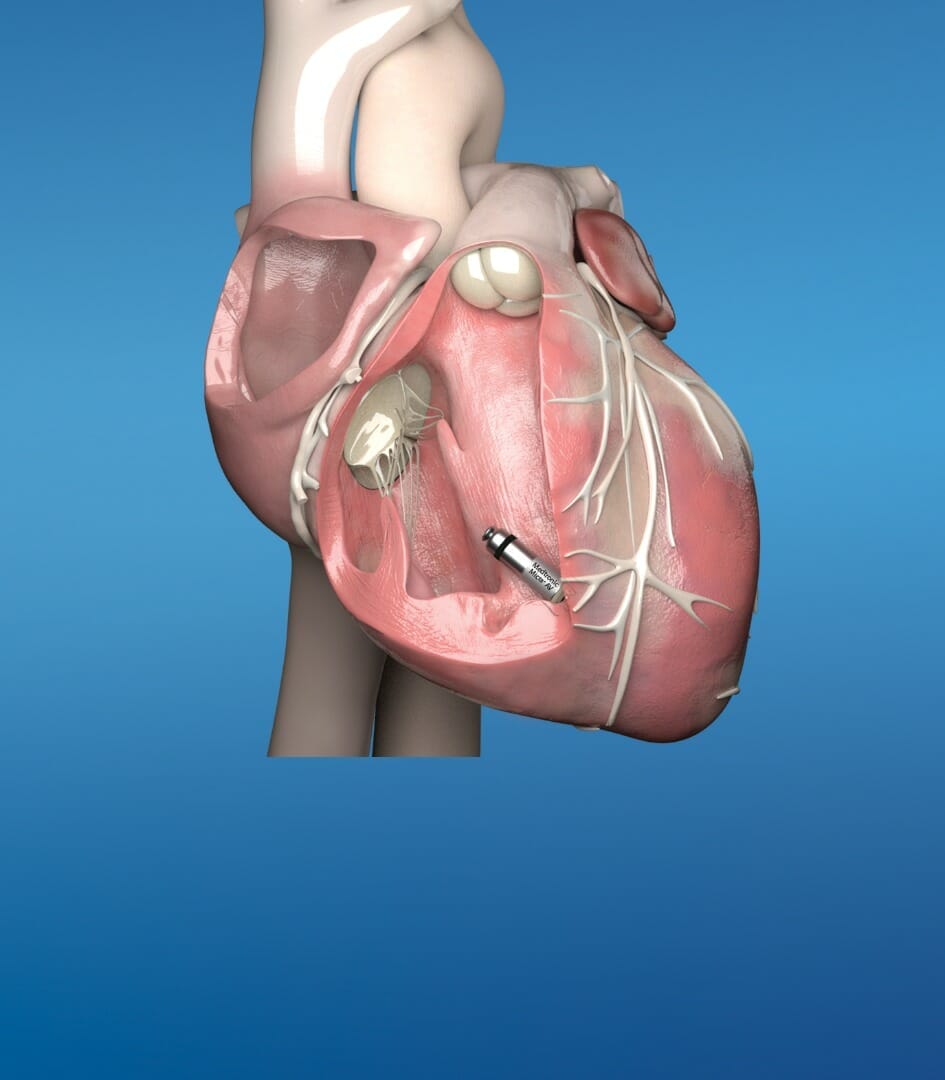 IJN becomes first hospital in the region to successfully implant Micra ...